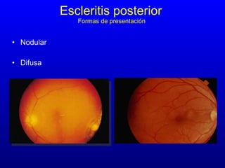 Oftalmologia - Escleritis Posterior | PPT