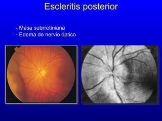 Oftalmologia - Escleritis Posterior | PPT | Eye and Vision Conditions ...