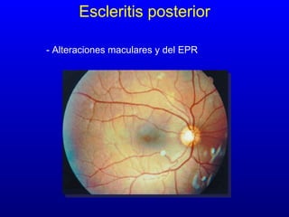 Oftalmologia - Escleritis Posterior | PPT | Eye and Vision Conditions ...