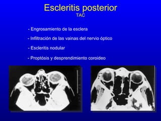 Oftalmologia - Escleritis Posterior | PPT | Eye and Vision Conditions ...
