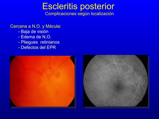 Oftalmologia - Escleritis Posterior | PPT | Eye and Vision Conditions ...