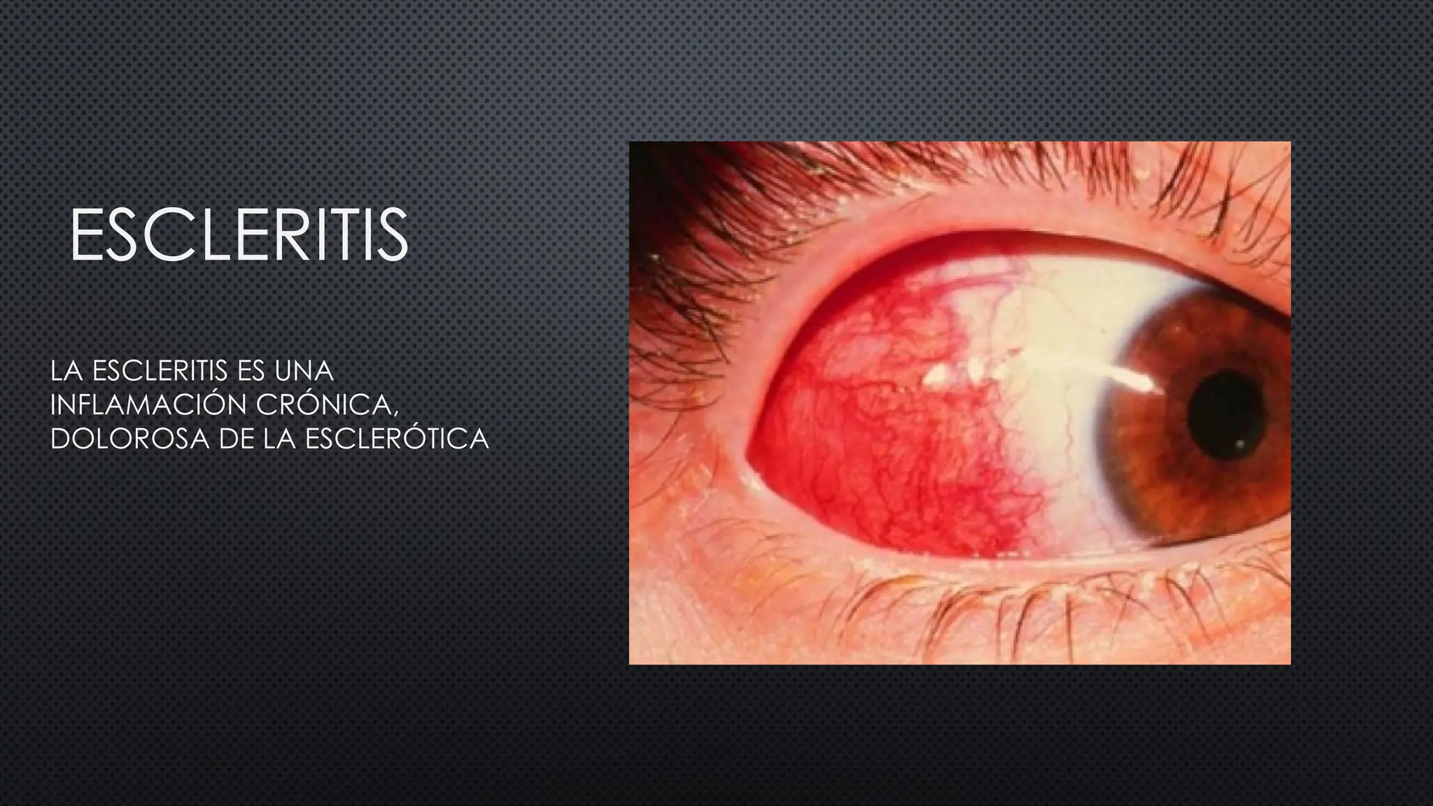 ESCLERITIS Y EPIESCLERITIS.pptx DEFINICION, ETIOLOGIA Y TRATAMIENTO ...