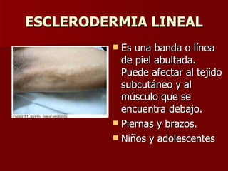 Esclerodermia | PPT
