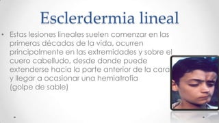 Esclerodermia | PPTX
