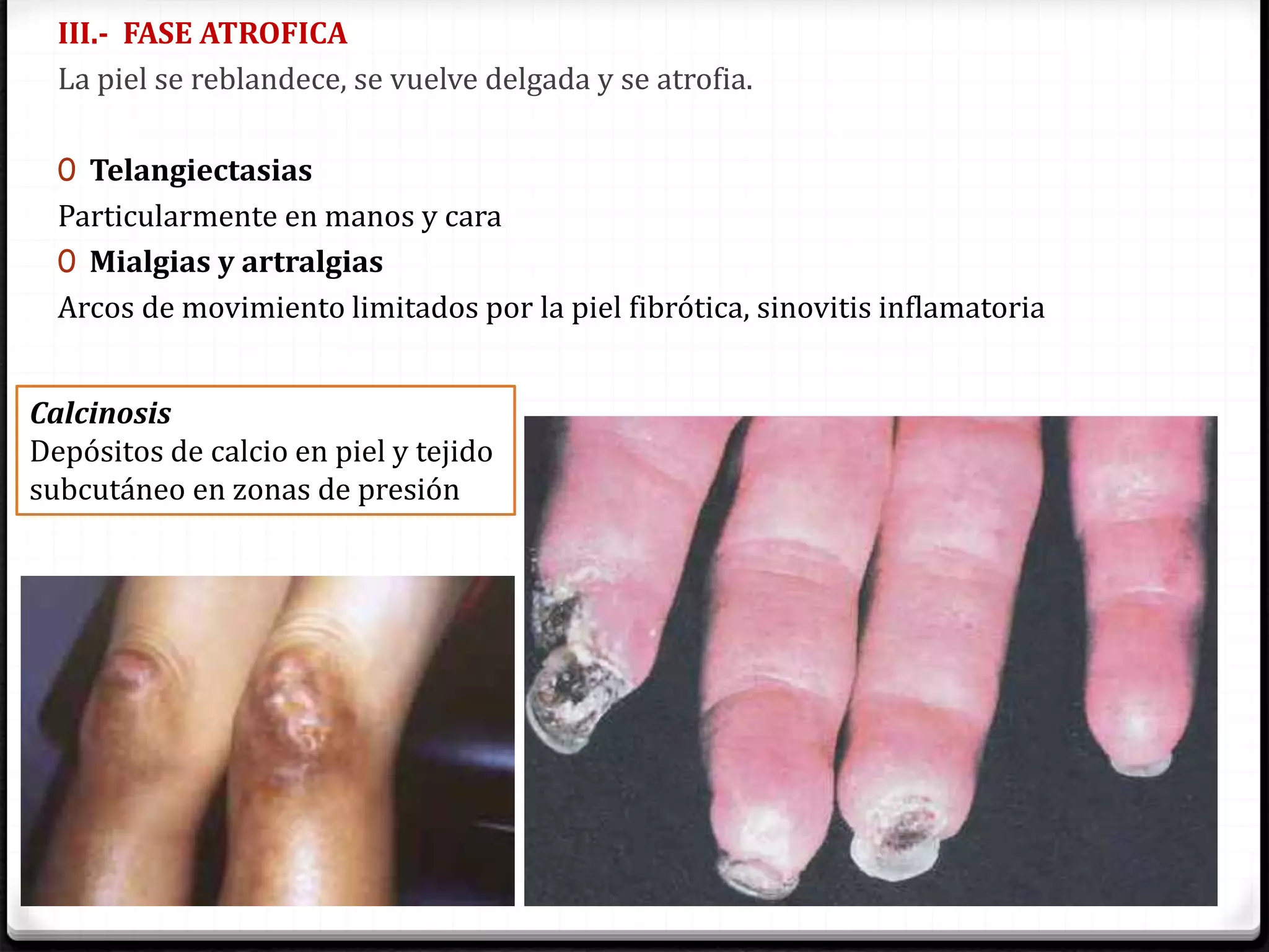 Esclerodermia (esclerosis sistemica) | PPTX