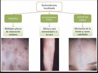 Esclerodermia (esclerosis sistemica) | PPTX