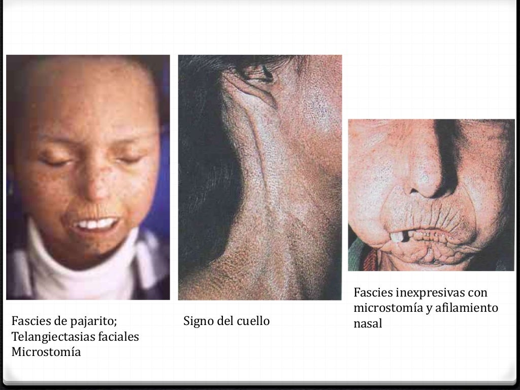 Esclerodermia (esclerosis sistemica)