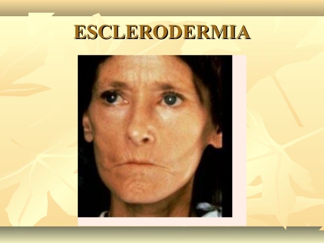 Esclerodermia