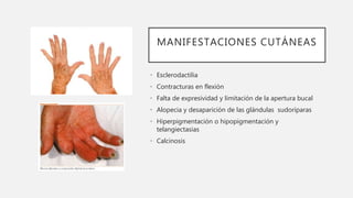 Esclerodermia. esclerosis multiple | PPTX