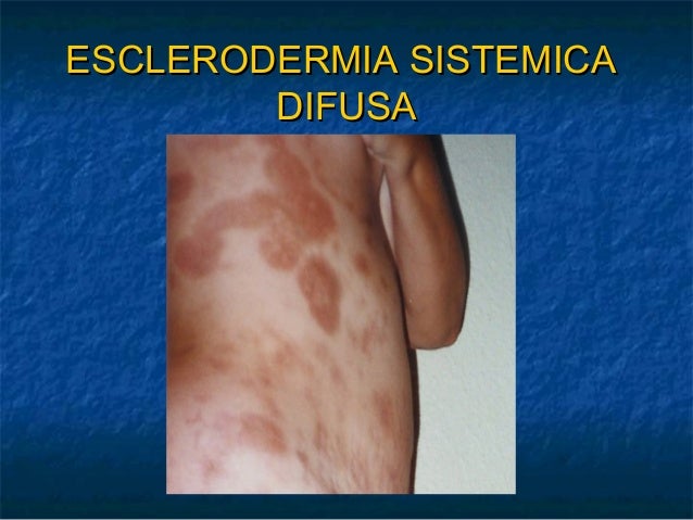 Esclerodermia en pediatria (1)