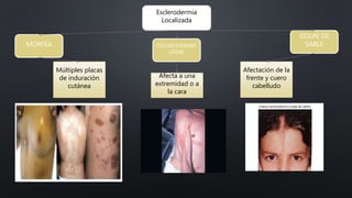 Esclerodermia | PPTX