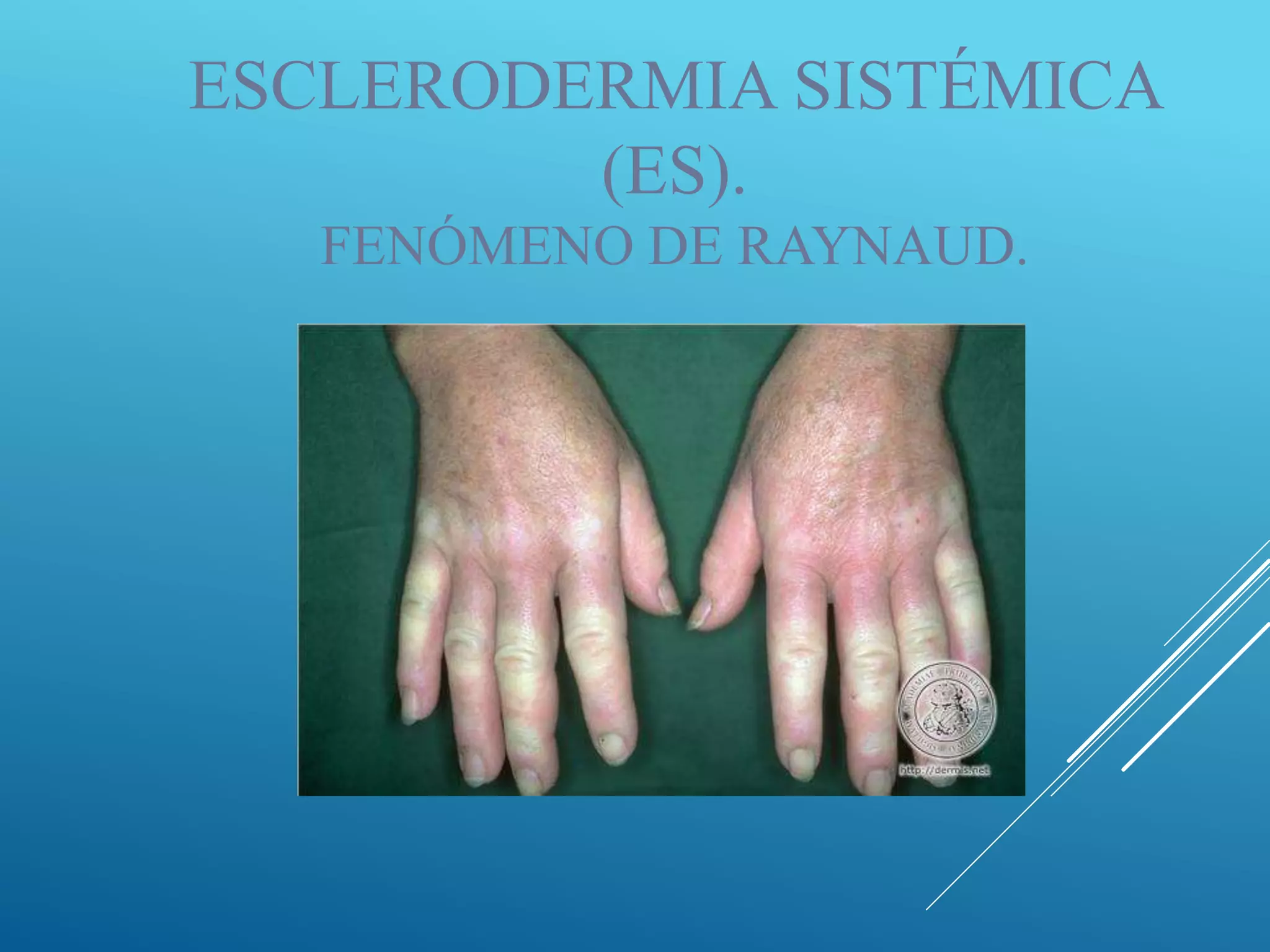 Esclerodermia sistemica manifestaciones cutaneas | PPTX