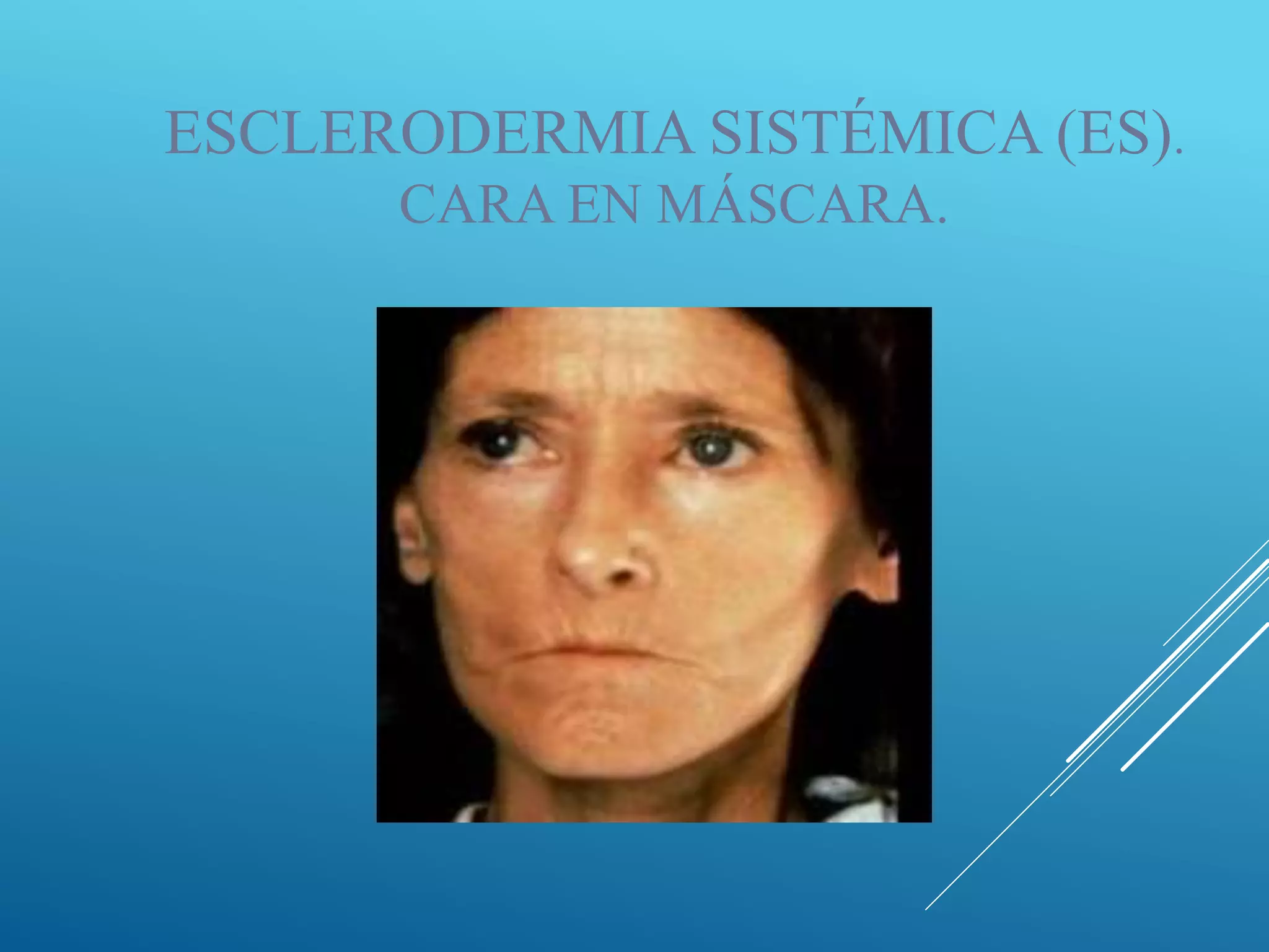 Esclerodermia sistemica manifestaciones cutaneas