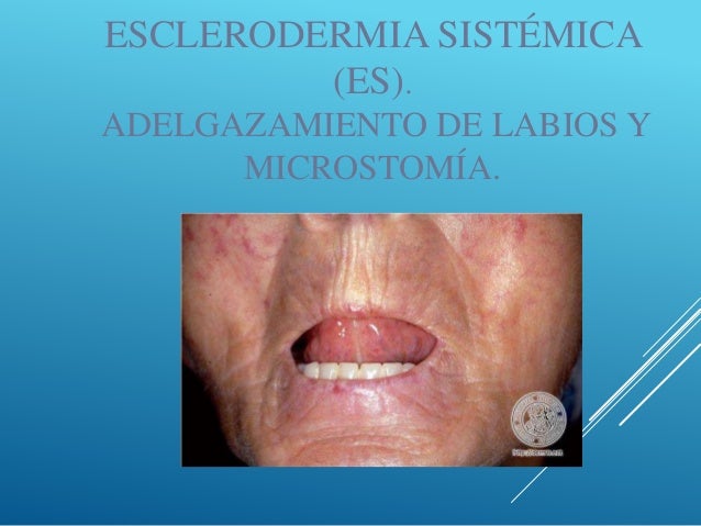 Esclerodermia sistemica manifestaciones cutaneas