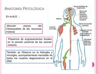 Esclerosis lateral amiotrófica | PPTX