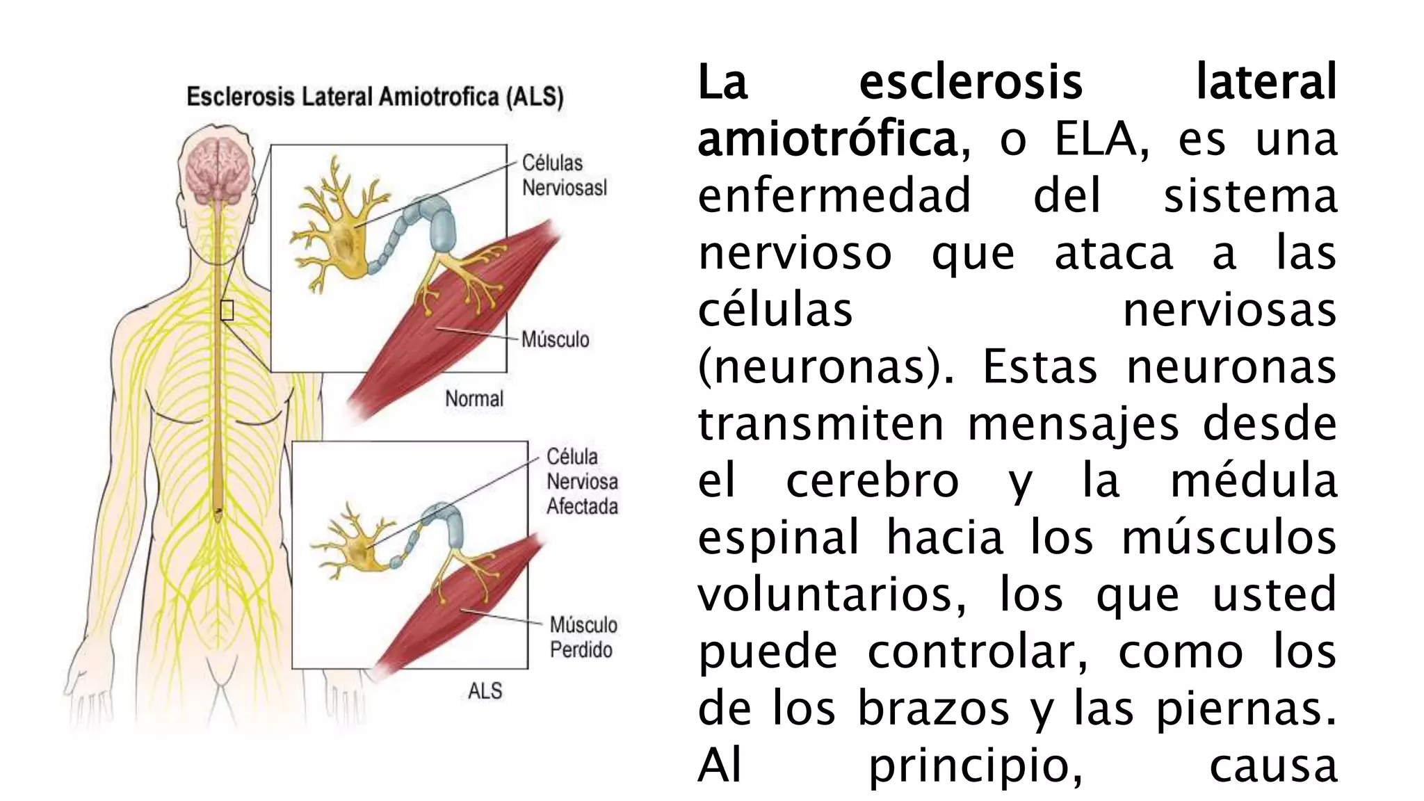 Esclerosis lateral amiotrófica | PPTX
