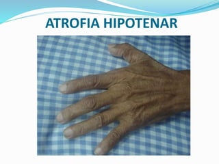 Esclerosis lateral amiotrofica | PPTX