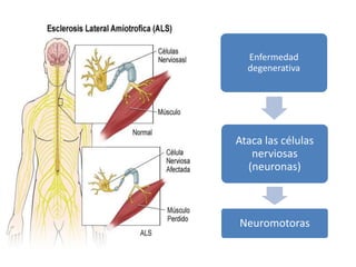 Esclerosis lateral amiotrofica (ela) sustentacion | PPTX