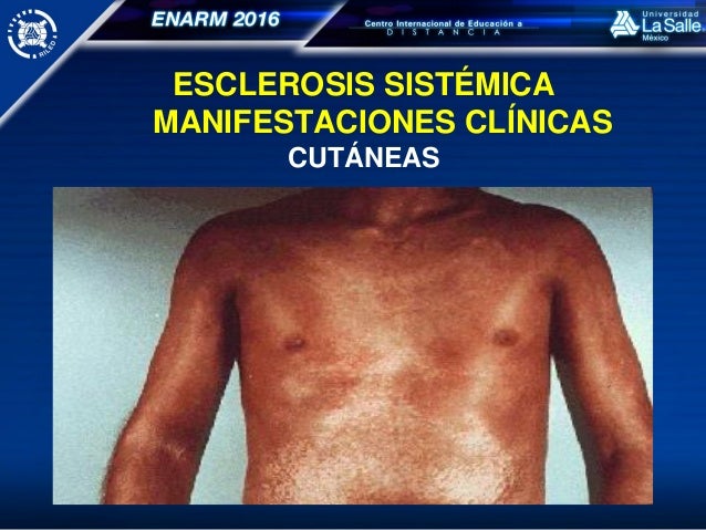 Esclerosis sistemica