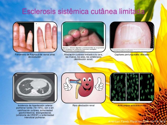 Esclerosis sistemica