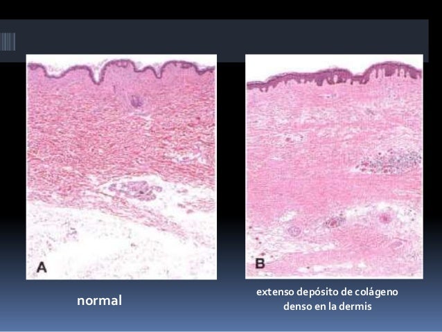 Esclerosis sistemica progresiva