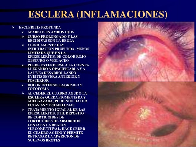 Esclerotica 121205174005-phpapp02