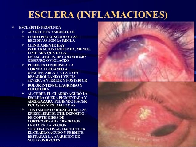Esclerotica