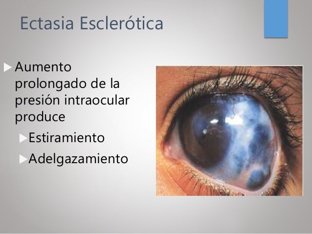 Esclerotica