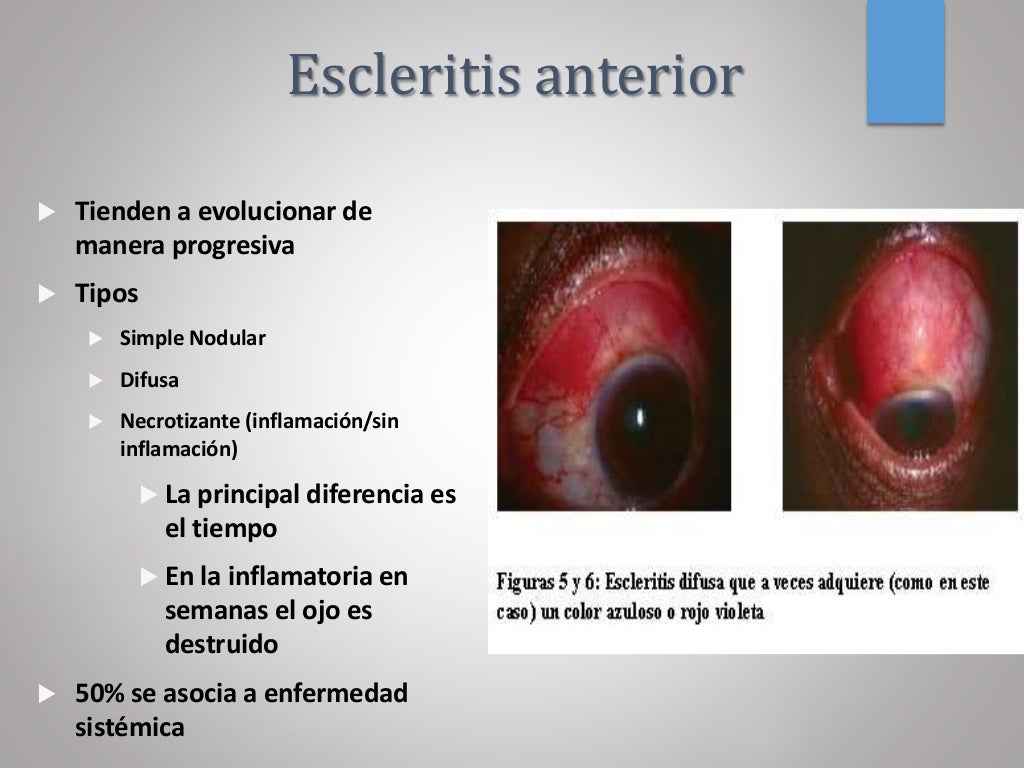 Esclerotica