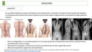Escoliosis | PPTX