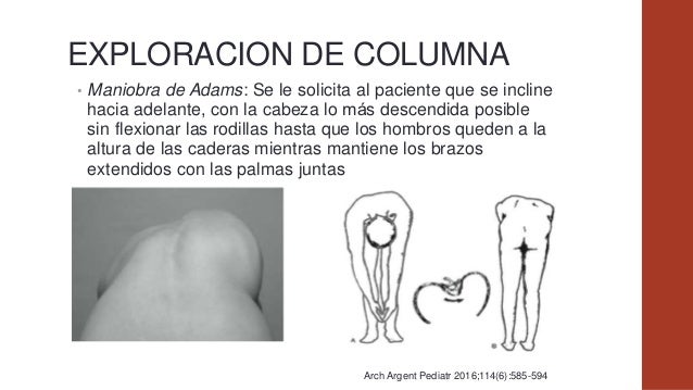 Escoliosis ideopatica