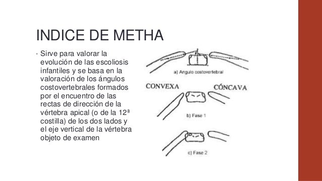 Escoliosis Ideopatica