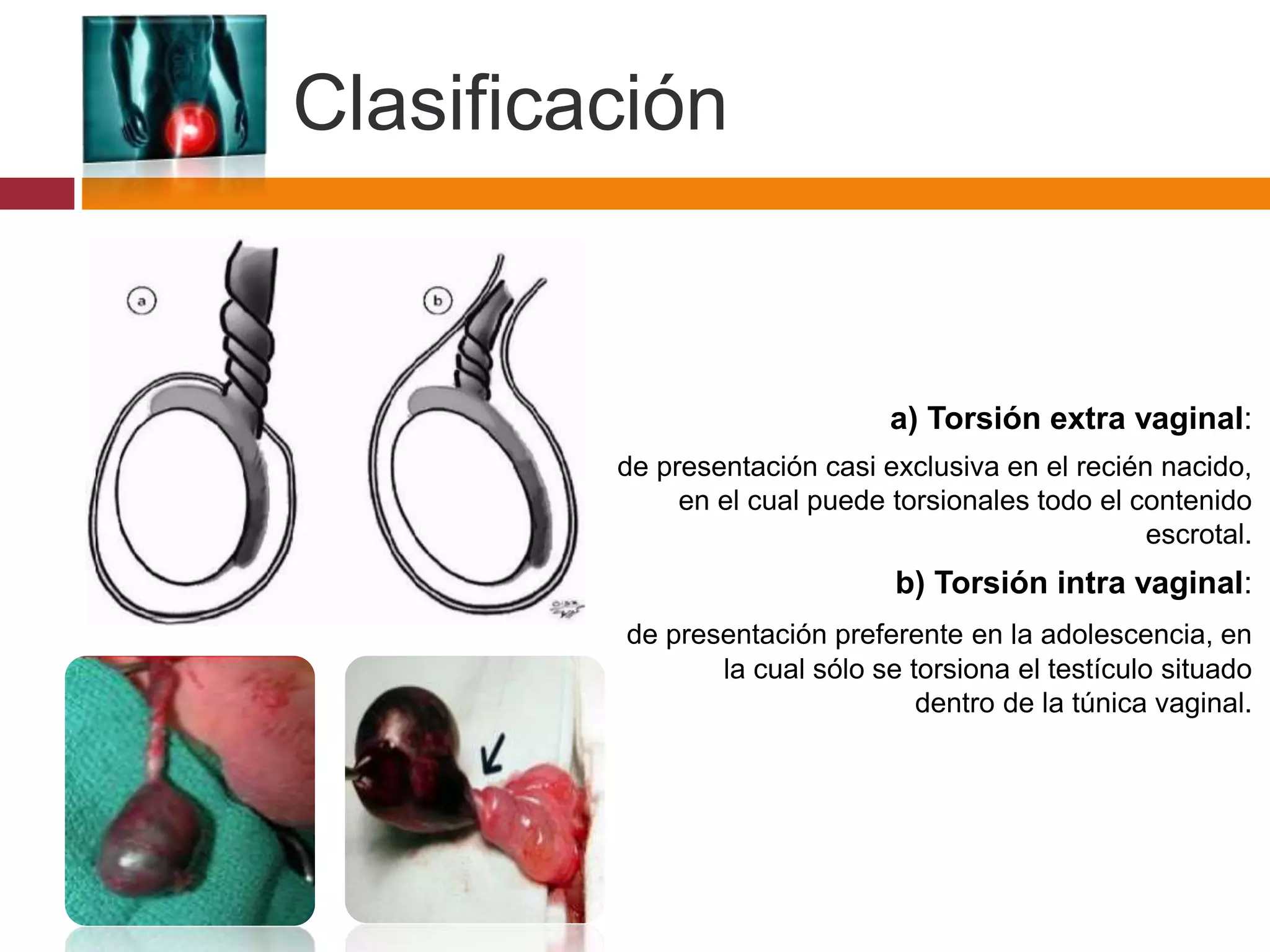 Urgencias Urologicas - Escroto Agudo | PPTX