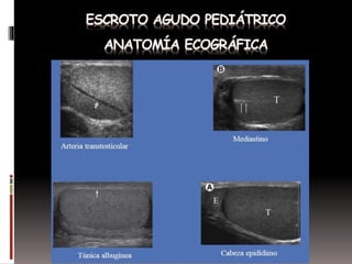 Escroto agudo en pediatría | PPTX