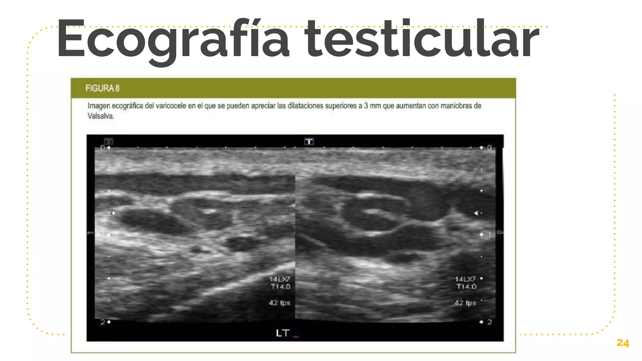 Escroto agudo urologia | PPTX