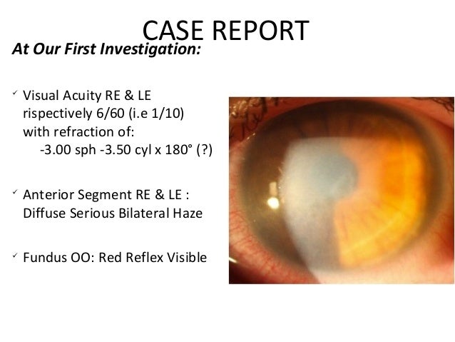 Irregular Astigmatism After Dsaek