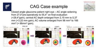 Anterior chamber (AC) angle, AC depth, AC volume variation after phaco ...