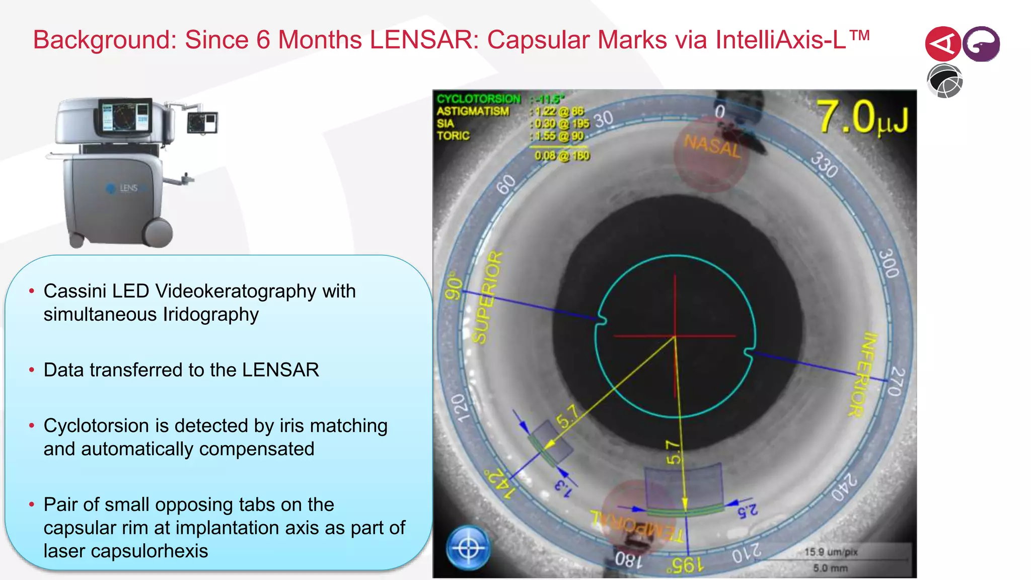 Alignment of Toric IOL via automated Femtosecond Laser-Assisted ...