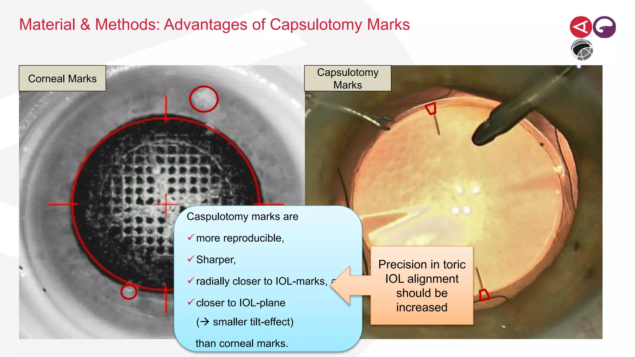 Alignment of Toric IOL via automated Femtosecond Laser-Assisted ...