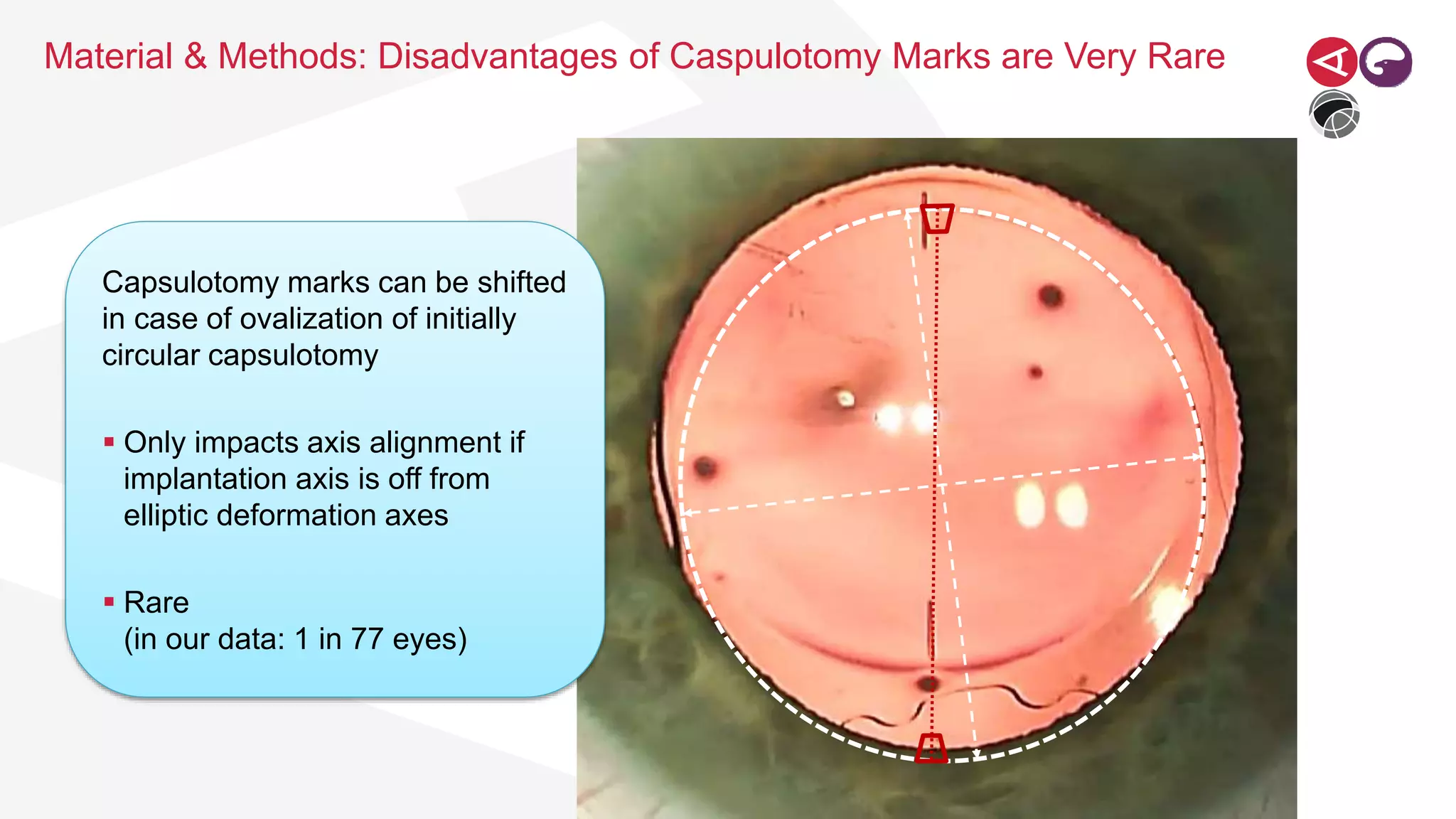 Alignment of Toric IOL via automated Femtosecond Laser-Assisted ...