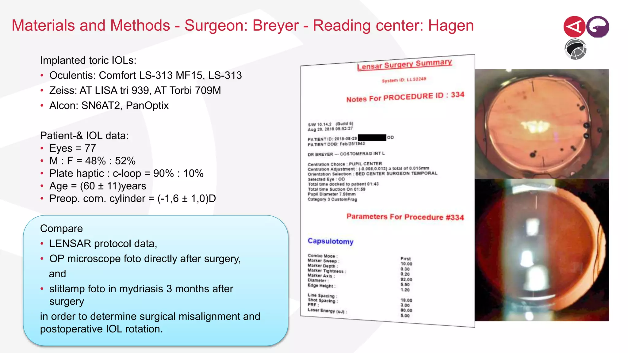 Alignment of Toric IOL via automated Femtosecond Laser-Assisted ...