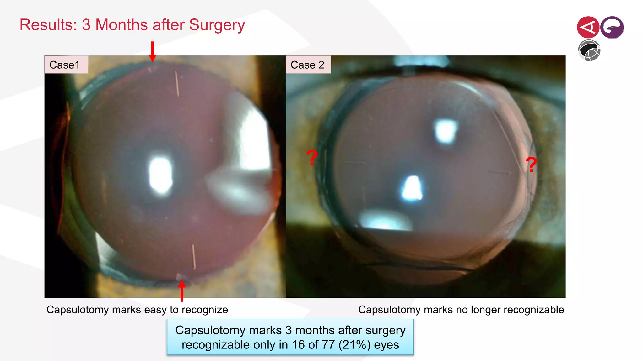 Alignment of Toric IOL via automated Femtosecond Laser-Assisted ...