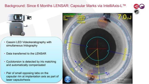 Alignment of Toric IOL via automated Femtosecond Laser-Assisted ...