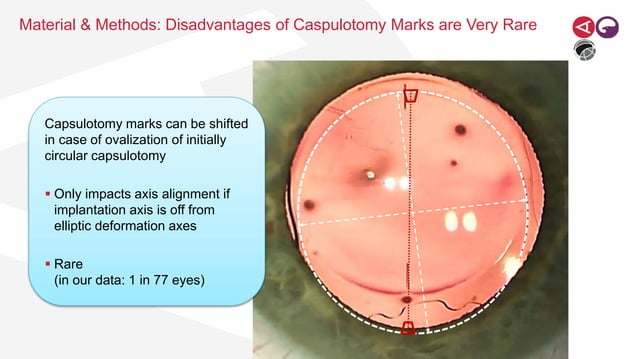 Alignment of Toric IOL via automated Femtosecond Laser-Assisted ...