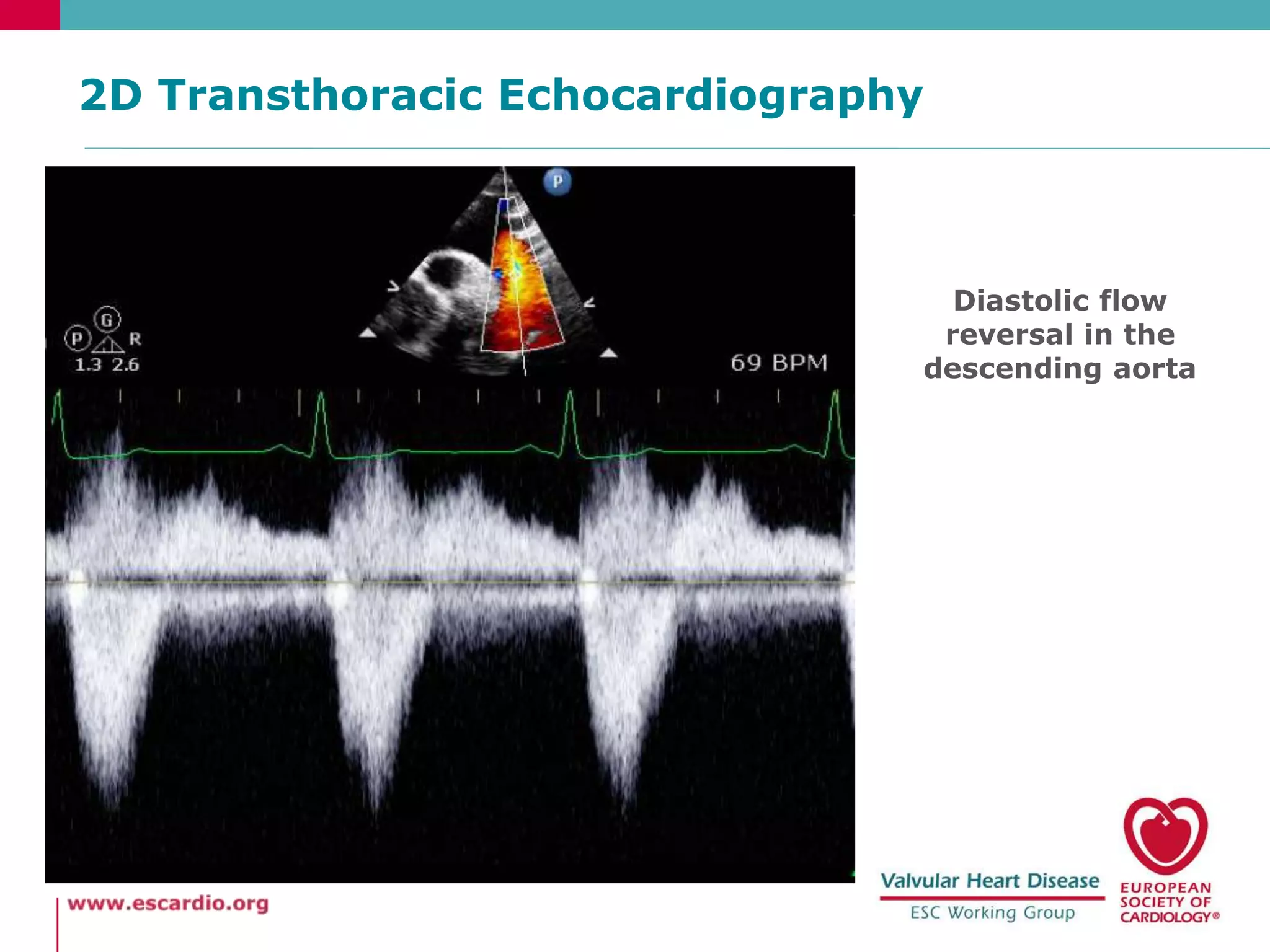 Aortic Regurgitation secondary to RCC prolapse | PPTX