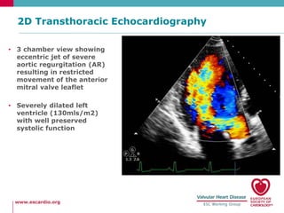 Aortic Regurgitation secondary to RCC prolapse | PPTX