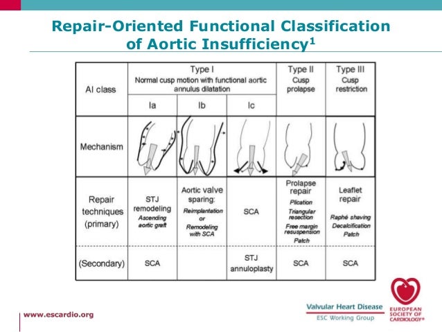 Aortic Regurgitation secondary to RCC prolapse