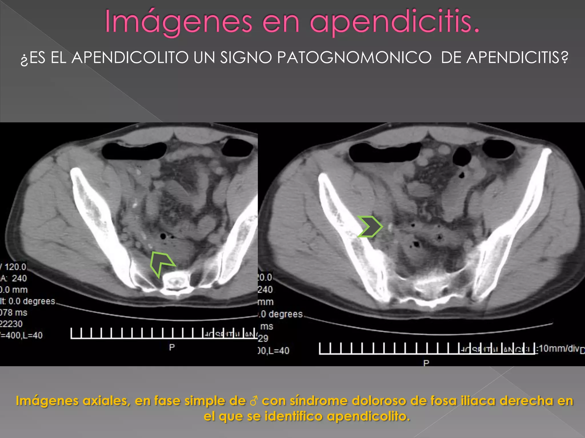 Es el apendicolito un signo patognomonico de apendicitis | PDF