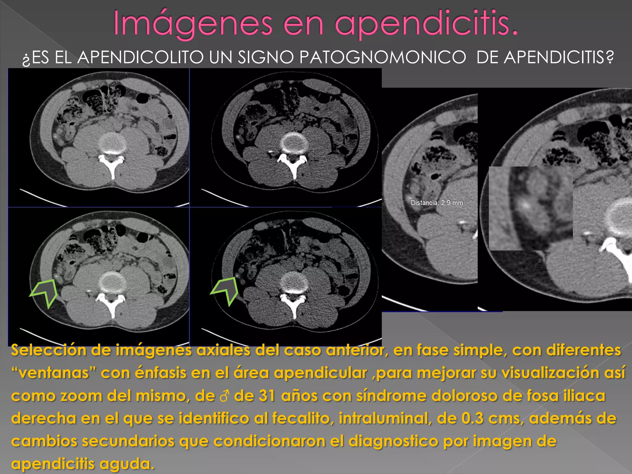 Es el apendicolito un signo patognomonico de apendicitis | PDF