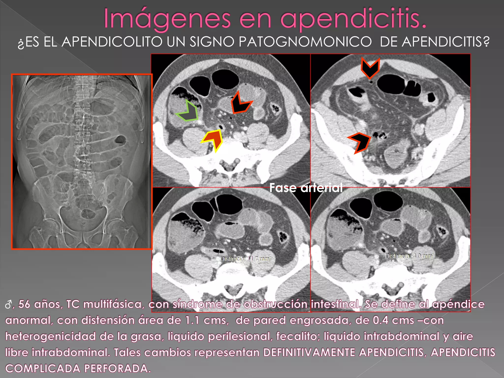 Es el apendicolito un signo patognomonico de apendicitis | PDF ...